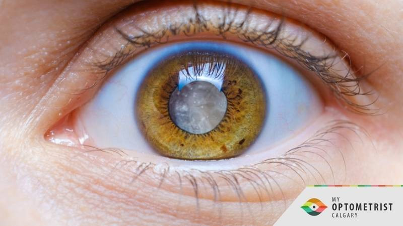 My Optometrist Calgary | Calgary Eye Doctor | Calgary Eye Exams